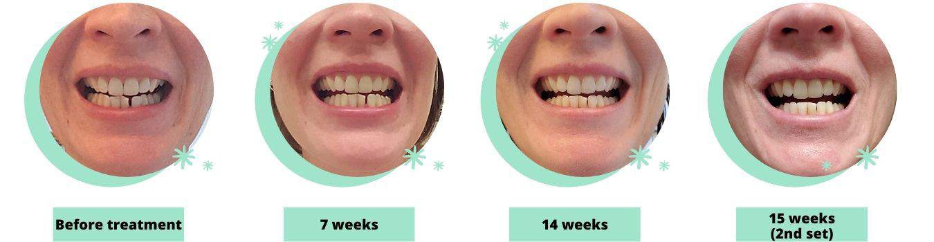 An Honest Byte Aligners Review: a Simple Solution on a Budget - The ...